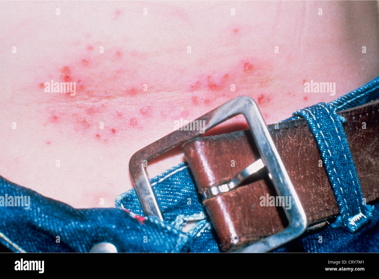 Eczéma de contact Banque de photographies et d’images à haute ...