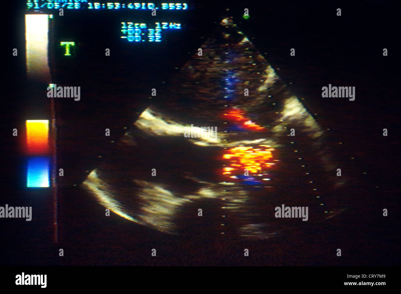 Mitral stenosis Banque de photographies et d’images à haute résolution ...