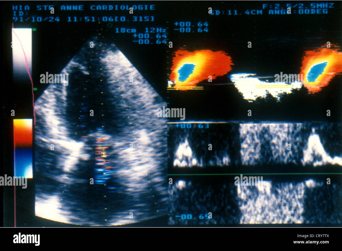 Insuffisance valvulaire cardiaque Banque de photographies et d’images à ...