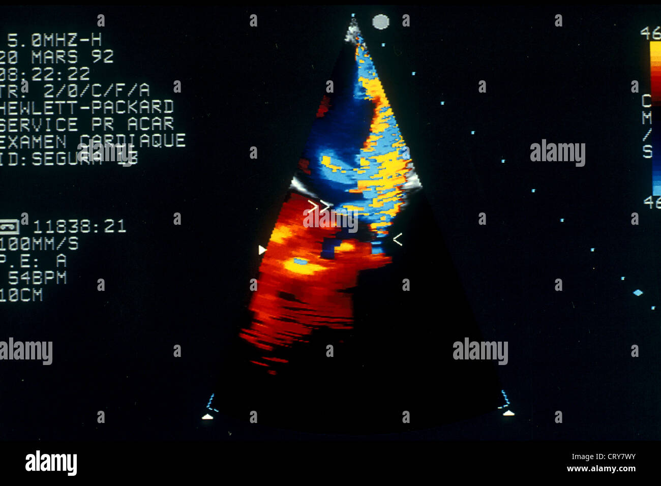 Insuffisance valvulaire cardiaque Banque de photographies et d’images à ...