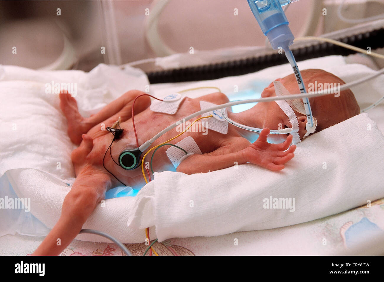 Phototherapy baby Banque de photographies et d’images à haute ...