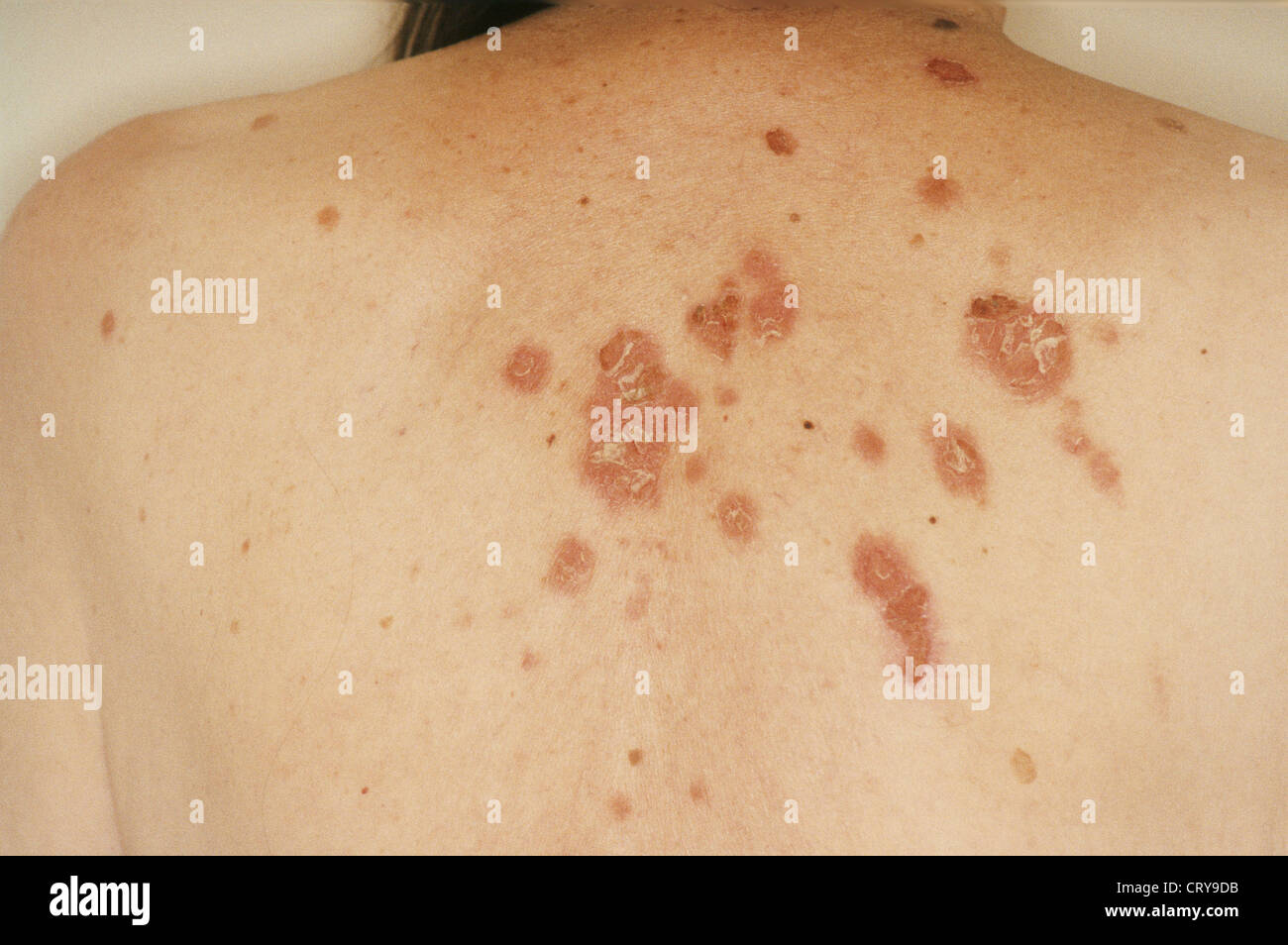 Erythematous rash Banque de photographies et d’images à haute ...