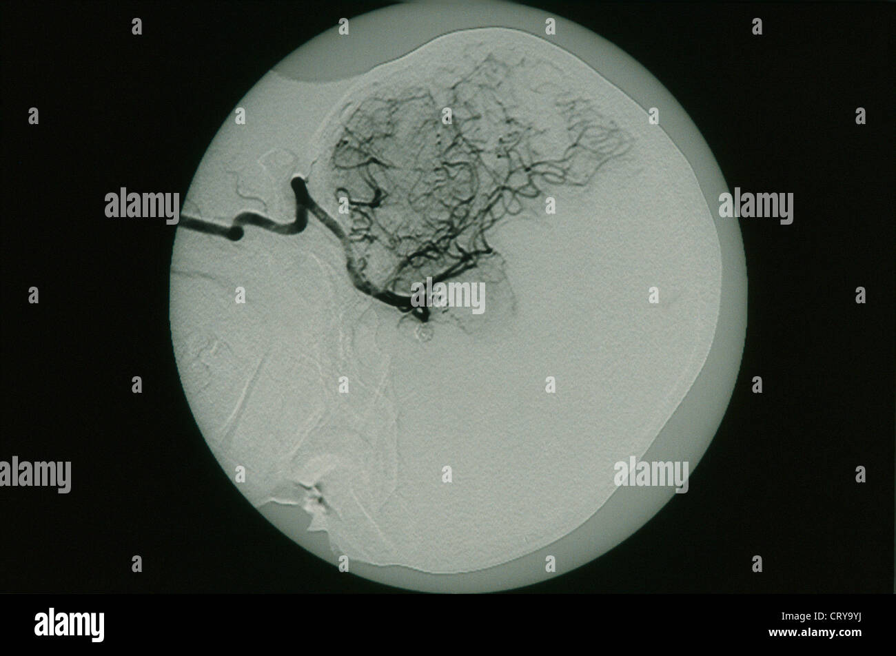 Vascularisation Cerebral Banque De Photographies Et Dimages à Haute