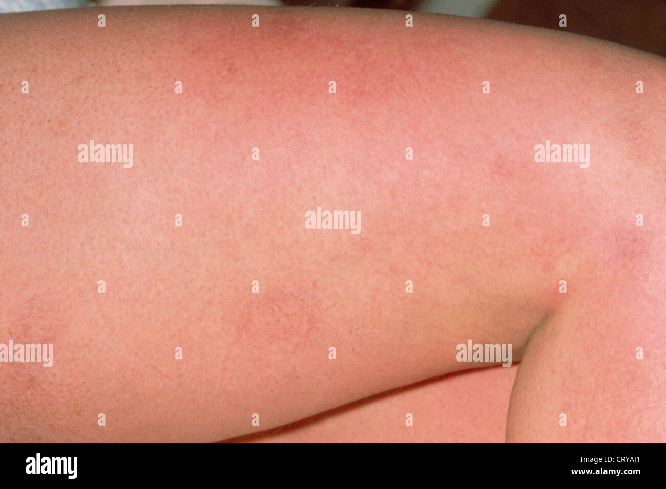 éruptions cutanées aux jambes Banque de photographies et d’images à ...