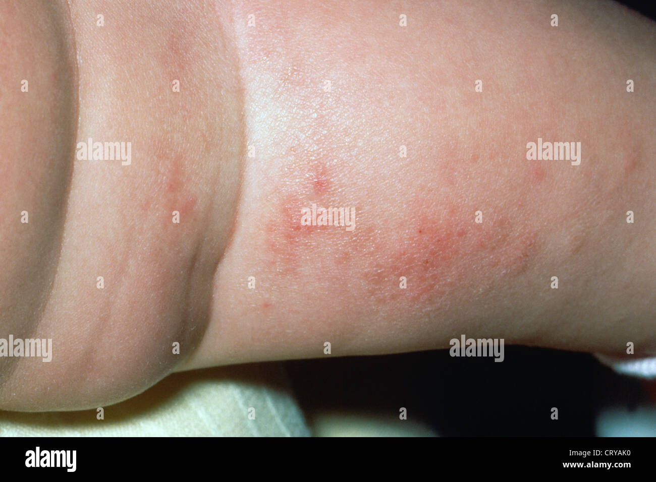 Eczéma atopique Banque de photographies et d’images à haute résolution ...
