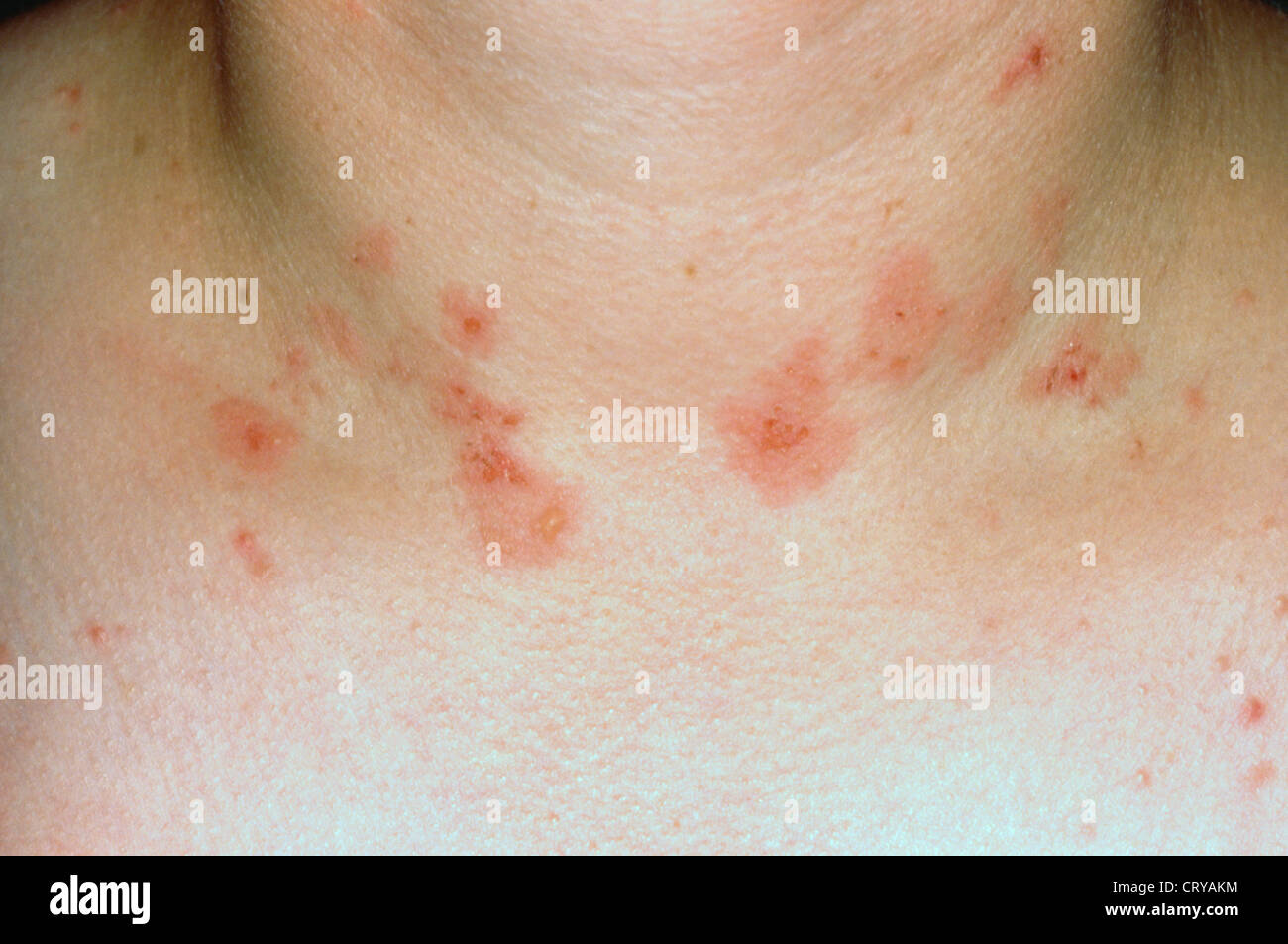 La dermatite herpétiforme Photo Stock - Alamy