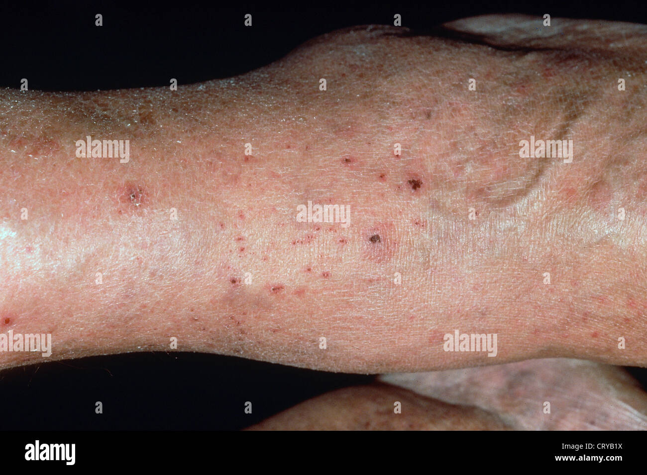 Purpura skin Banque de photographies et d’images à haute résolution - Alamy