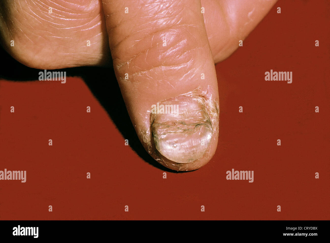 Fungal nail infections Banque de photographies et d’images à haute ...