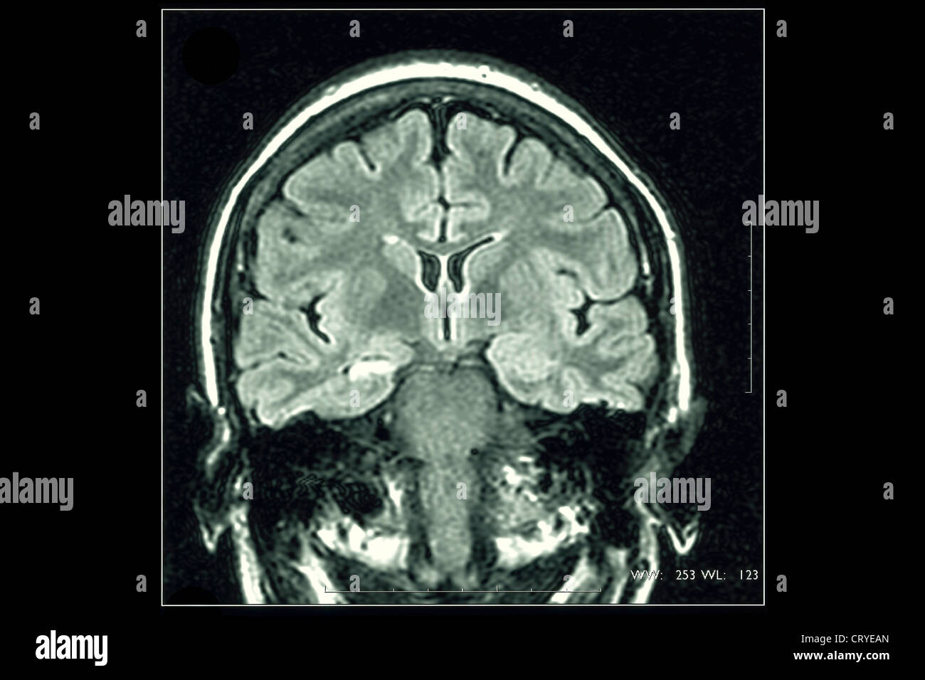 Flair mri Banque de photographies et d’images à haute résolution - Alamy