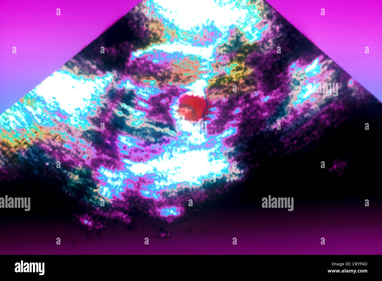 Fibrome utérin Banque de photographies et d’images à haute résolution ...