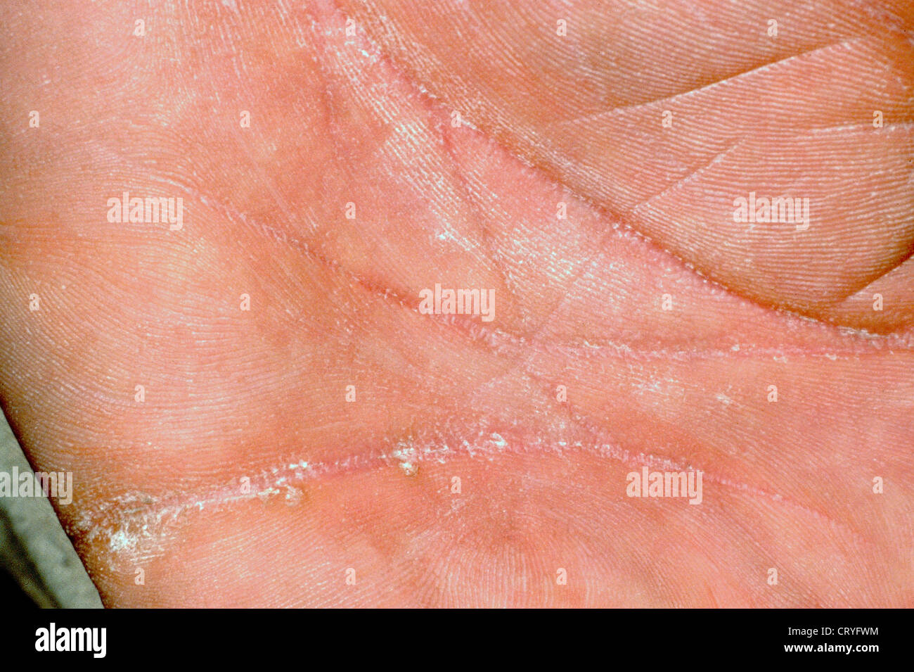 Mycose cutanée Banque de photographies et d’images à haute résolution ...