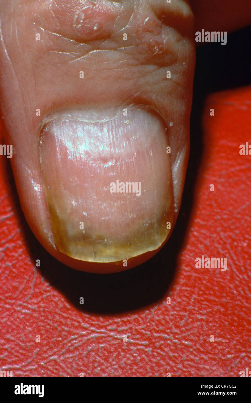 Psoriasis nails Banque de photographies et d’images à haute résolution ...