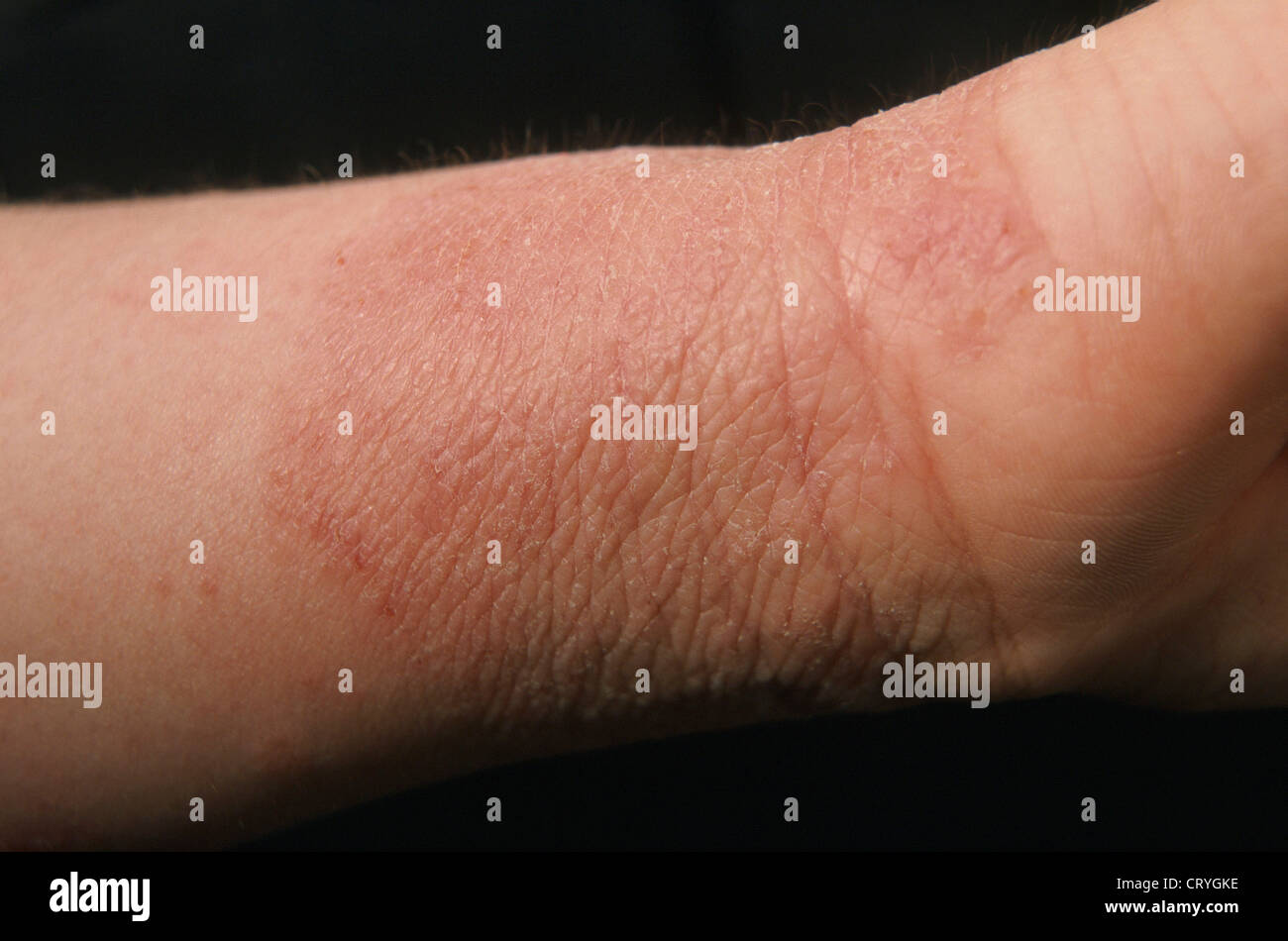 Contact dermatitis Banque de photographies et d’images à haute ...