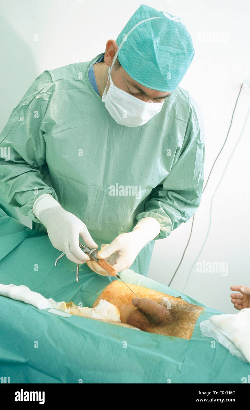La chirurgie EN PLASTIQUE SUR UN PÉNIS Photo Stock - Alamy