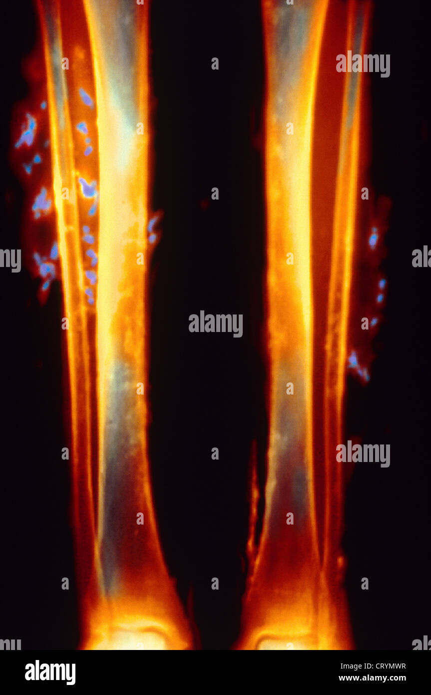 La maladie de Raynaud, X-RAY Photo Stock - Alamy