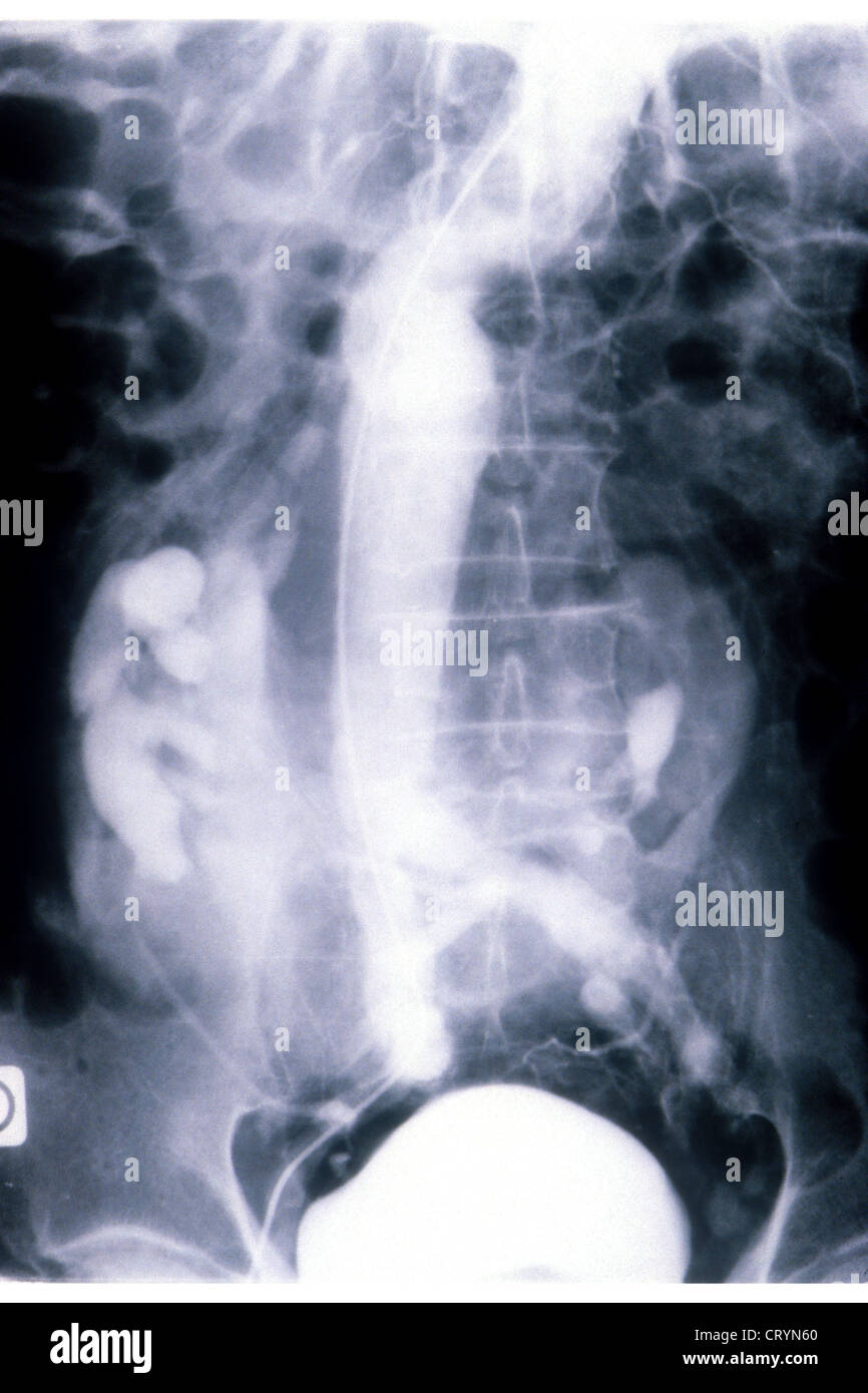 Kyste rénal, X-RAY Photo Stock - Alamy