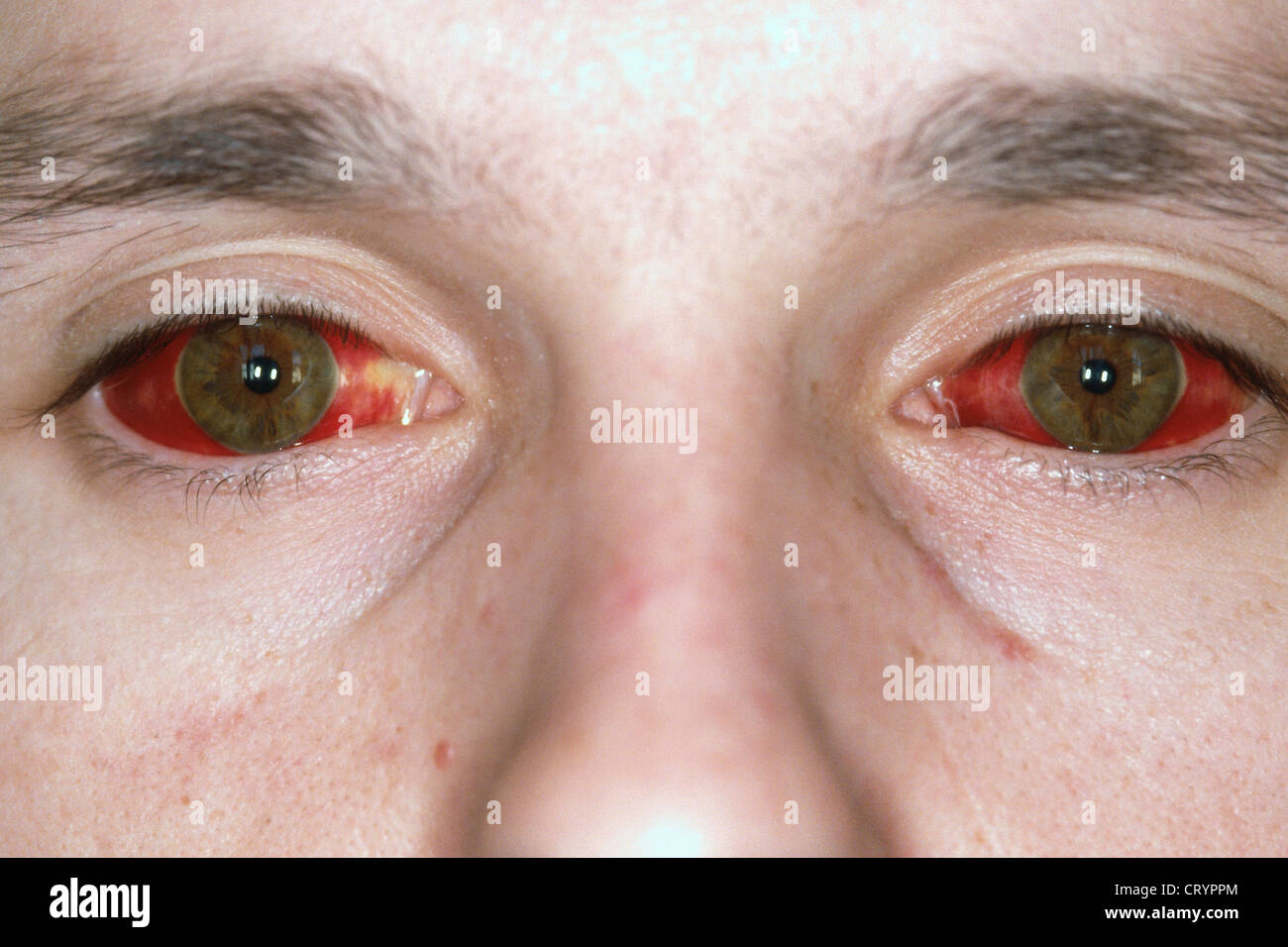 Conjonctivite virale Banque de photographies et d’images à haute ...