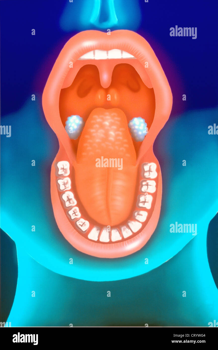 Amygdales palatines Banque de photographies et d’images à haute ...