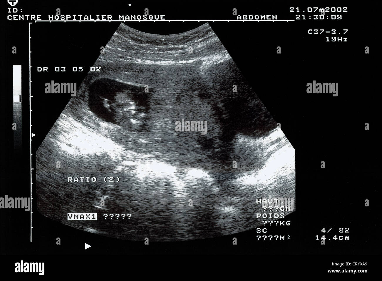 Fibrome utérin, l'échographie Photo Stock - Alamy