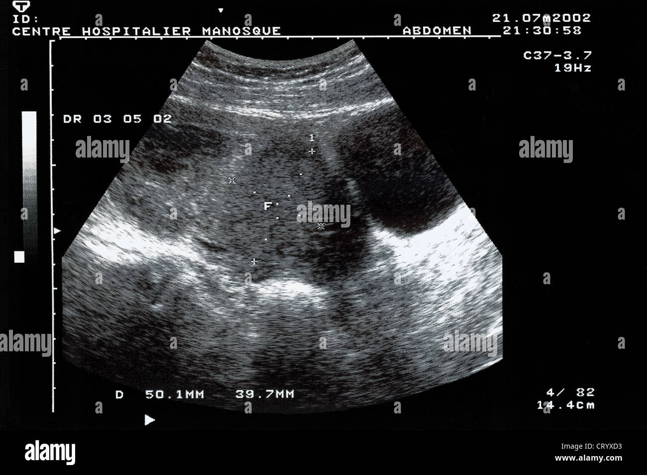 Fibrome utérin, l'échographie Photo Stock - Alamy