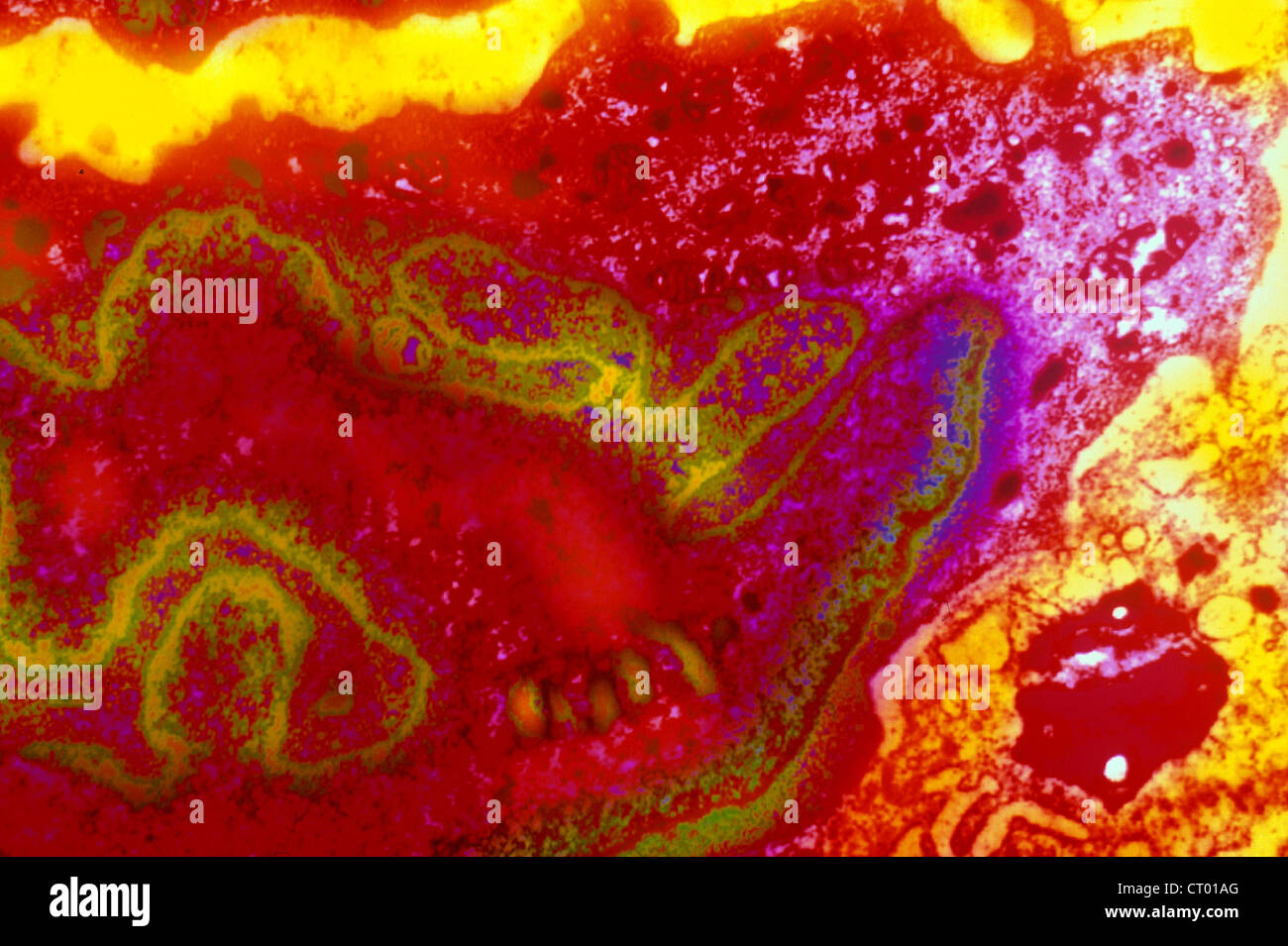 Leucemie aiguë Banque de photographies et d’images à haute résolution ...