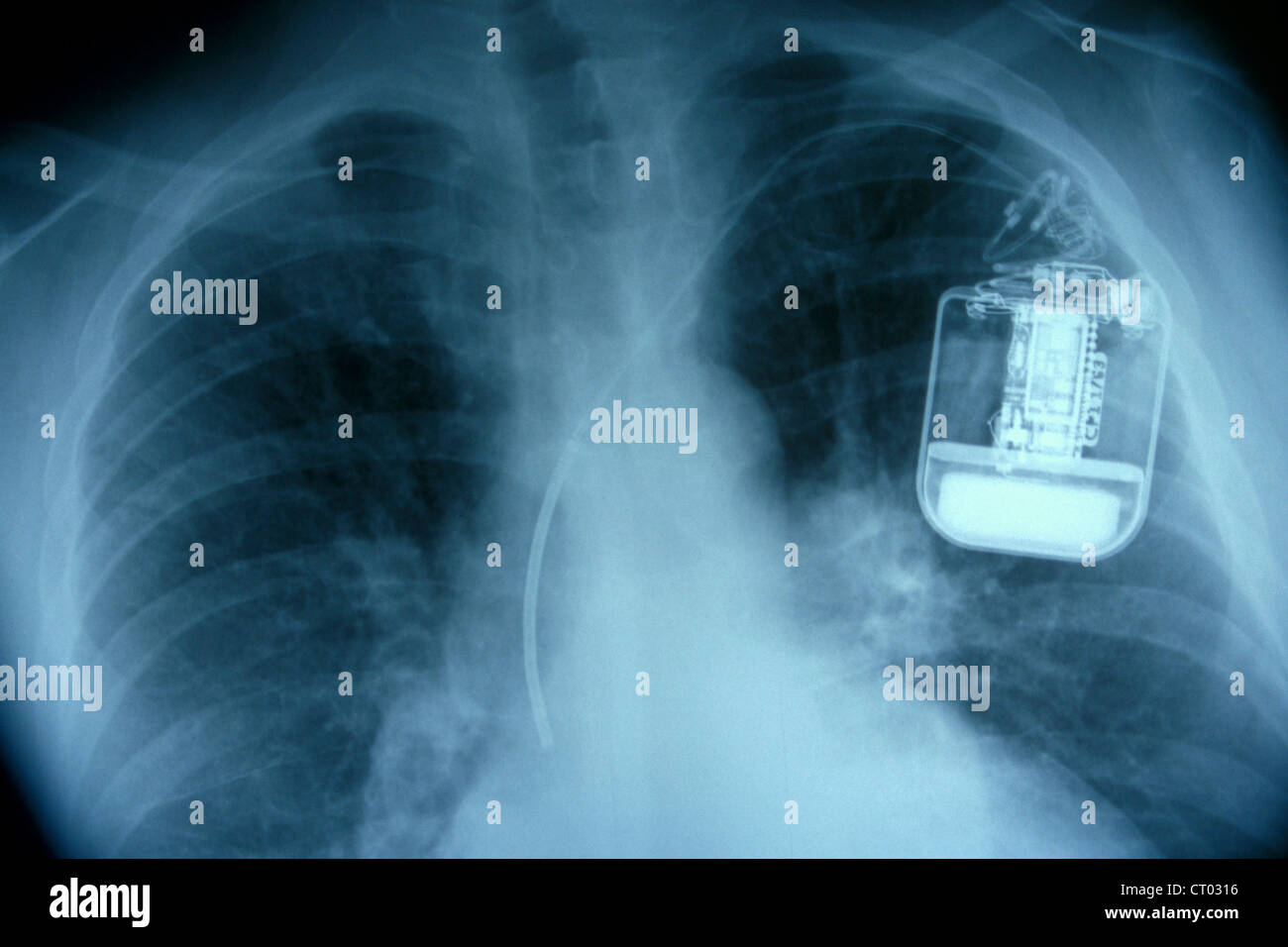 Radiographie du stimulateur cardiaque Banque de photographies et d ...
