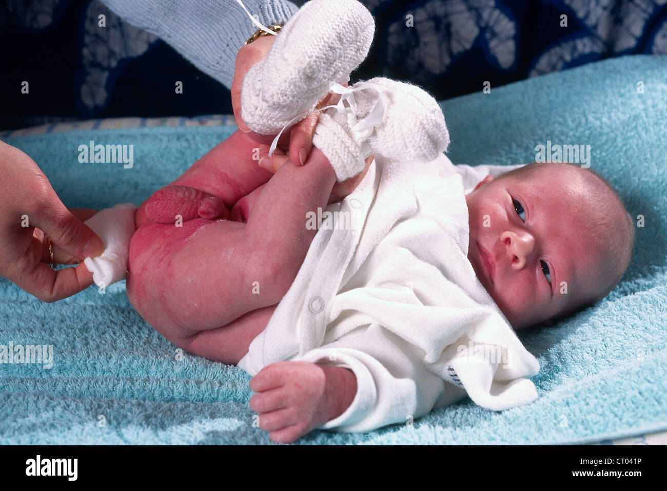 érythème fessier Banque de photographies et d’images à haute résolution ...