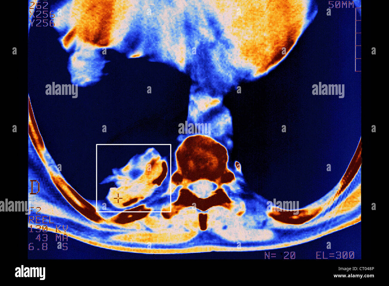 Asbestose poumons Banque de photographies et d’images à haute ...