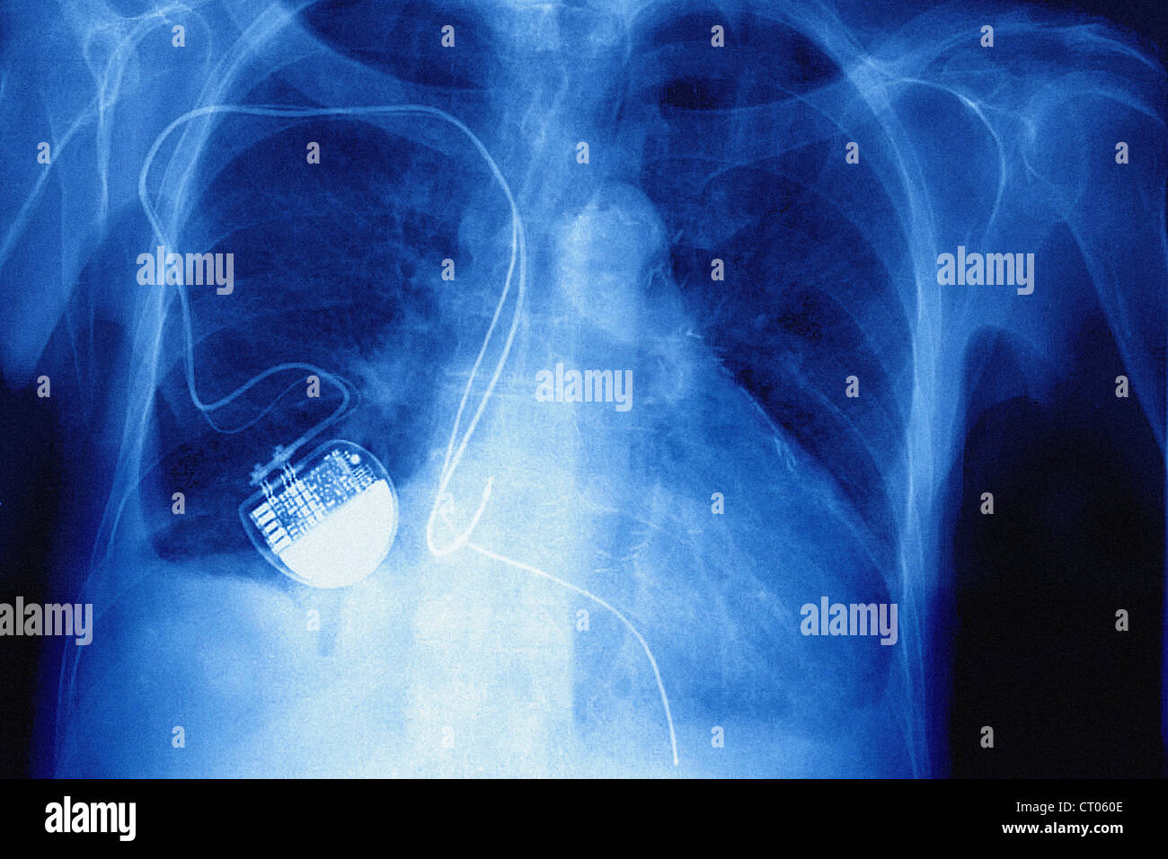 Radiographie du stimulateur cardiaque Banque de photographies et d ...