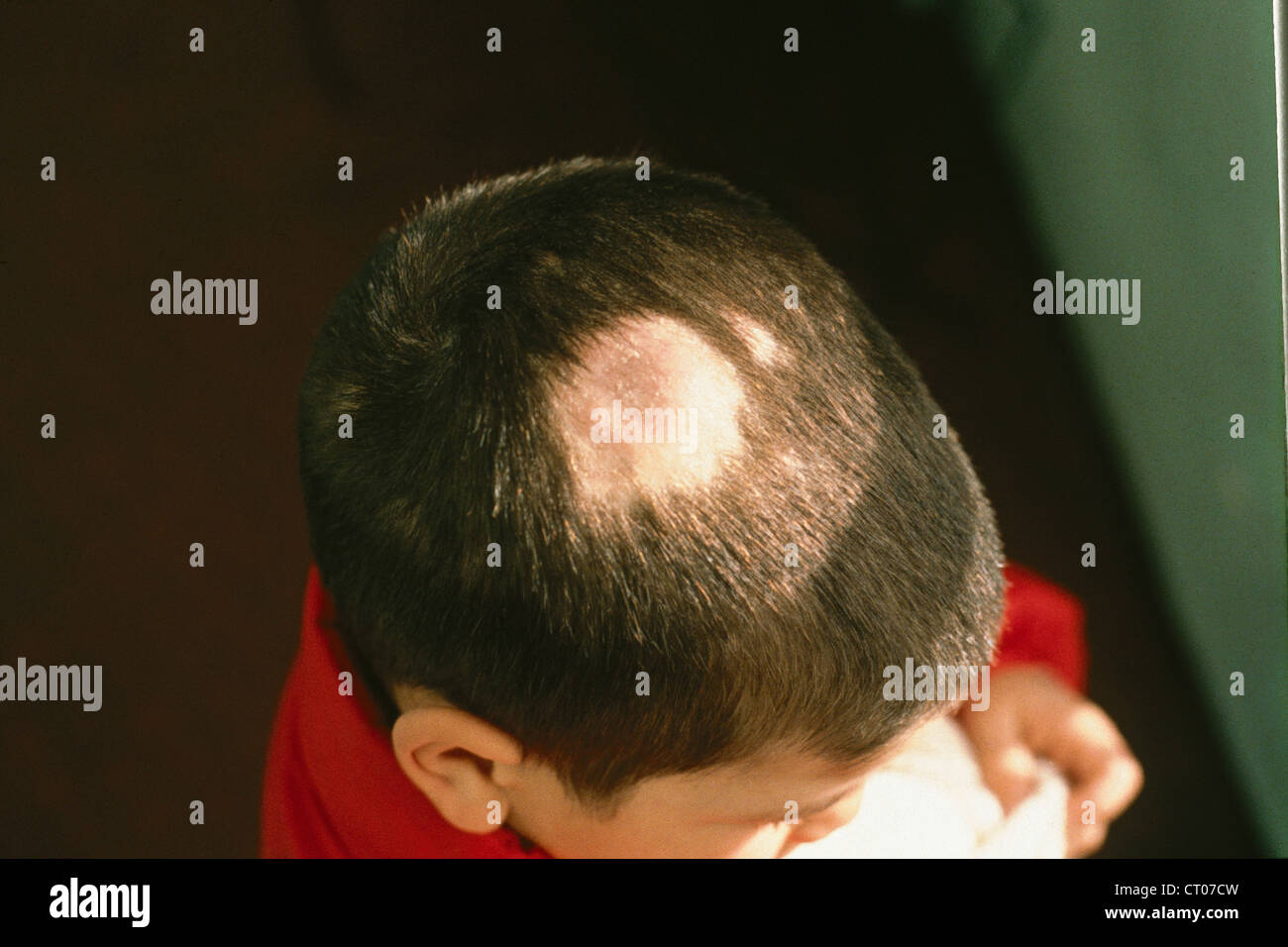 Teigne du cuir chevelu Banque de photographies et d’images à haute ...