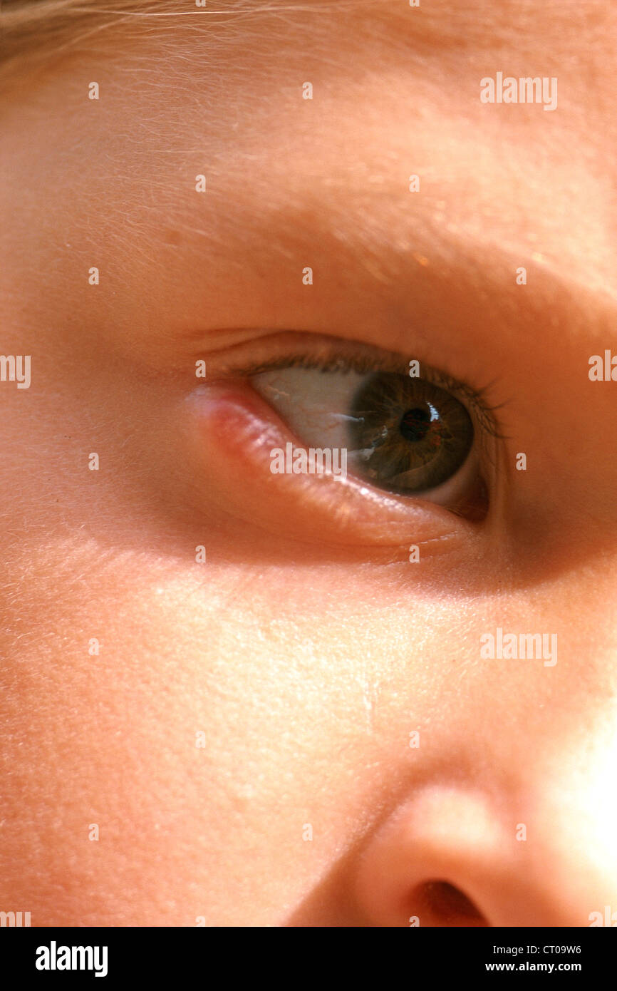 Kyste oculaire Banque de photographies et d’images à haute résolution ...