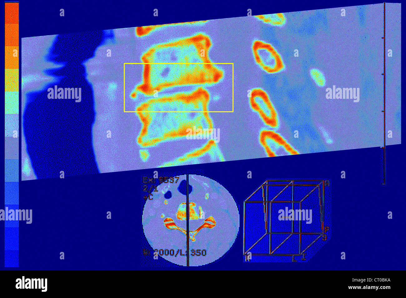 Resonancia magnética de la columna cervical Banque de photographies et ...