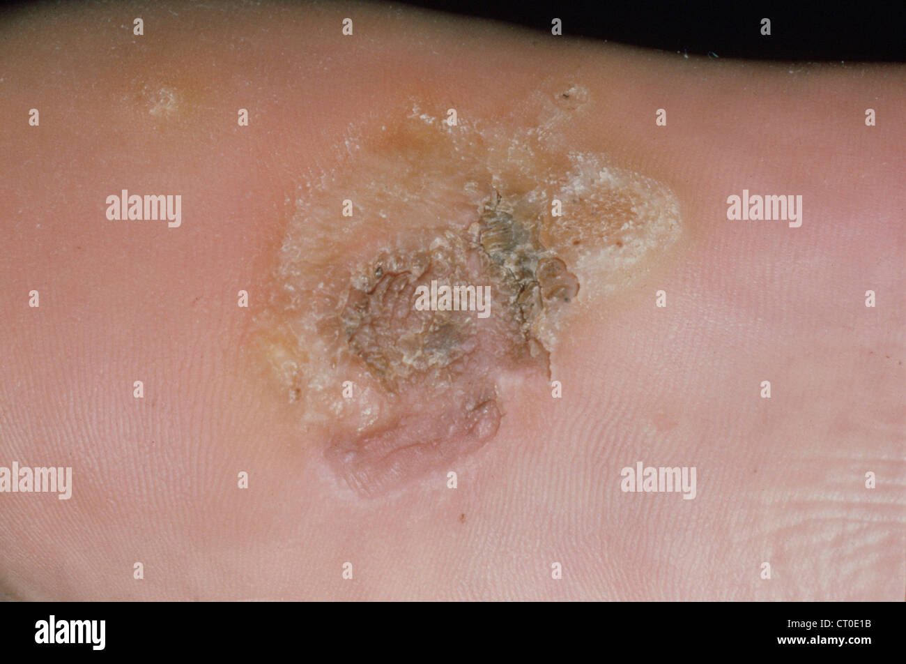 Verrues Cutanées Banque d'image et photos - Alamy