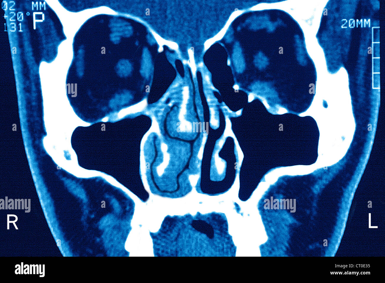 Image scanner des sinus Banque de photographies et d’images à haute ...