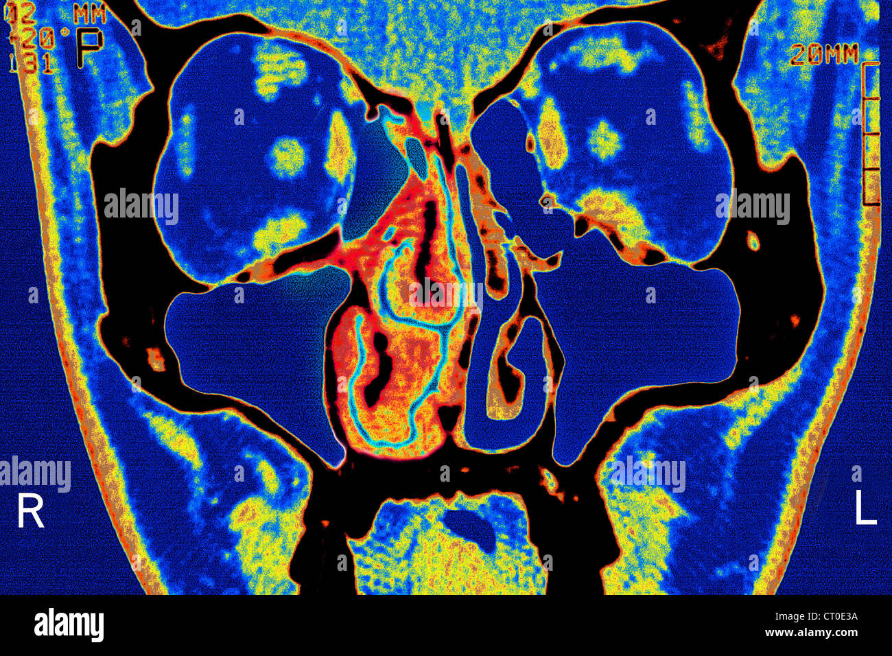 Image scanner des sinus Banque de photographies et d’images à haute ...