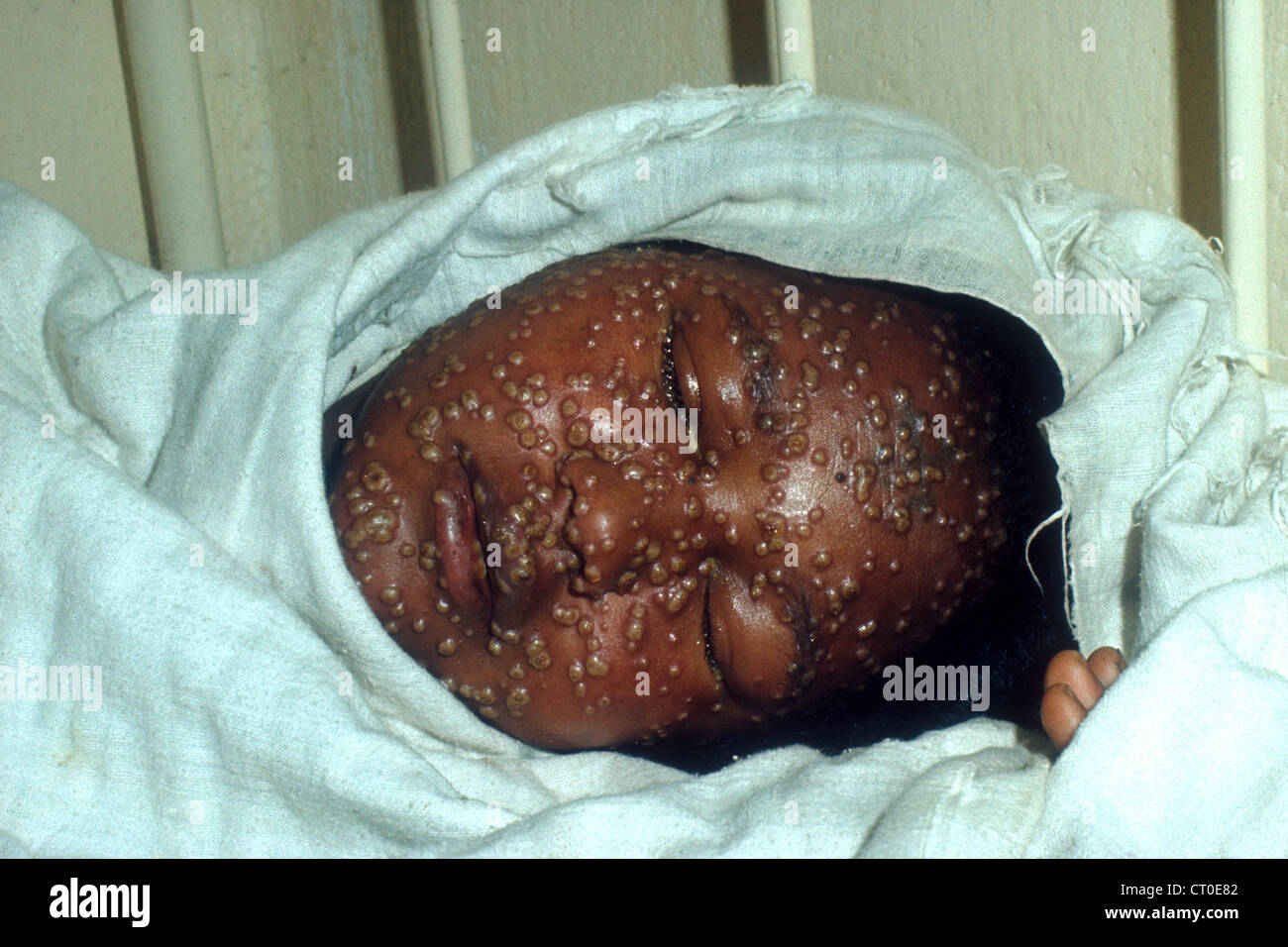 Variole Aviaire Banque d'image et photos - Alamy