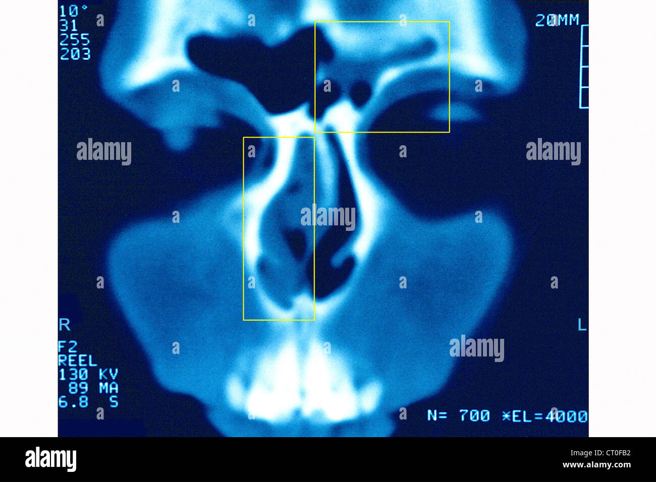 Image scanner des sinus Banque de photographies et d’images à haute ...