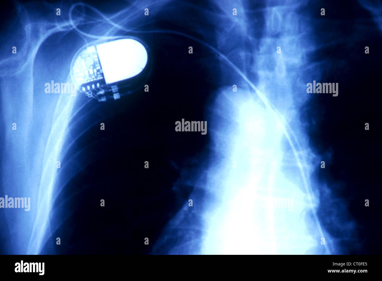 Radiographie du stimulateur cardiaque Banque de photographies et d ...