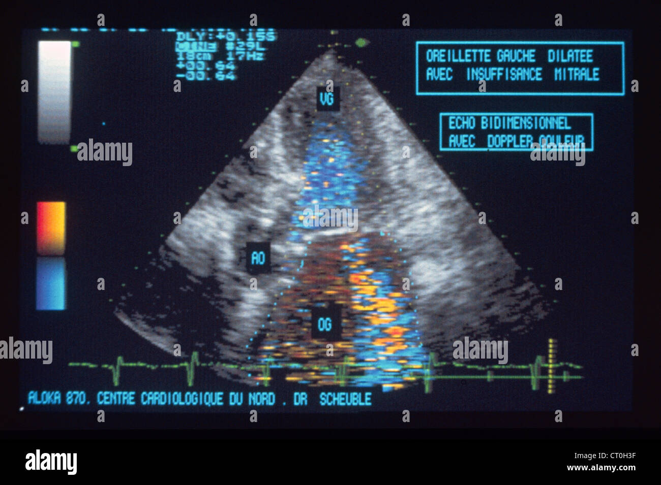 Insuffisance valvulaire cardiaque Banque de photographies et d’images à ...