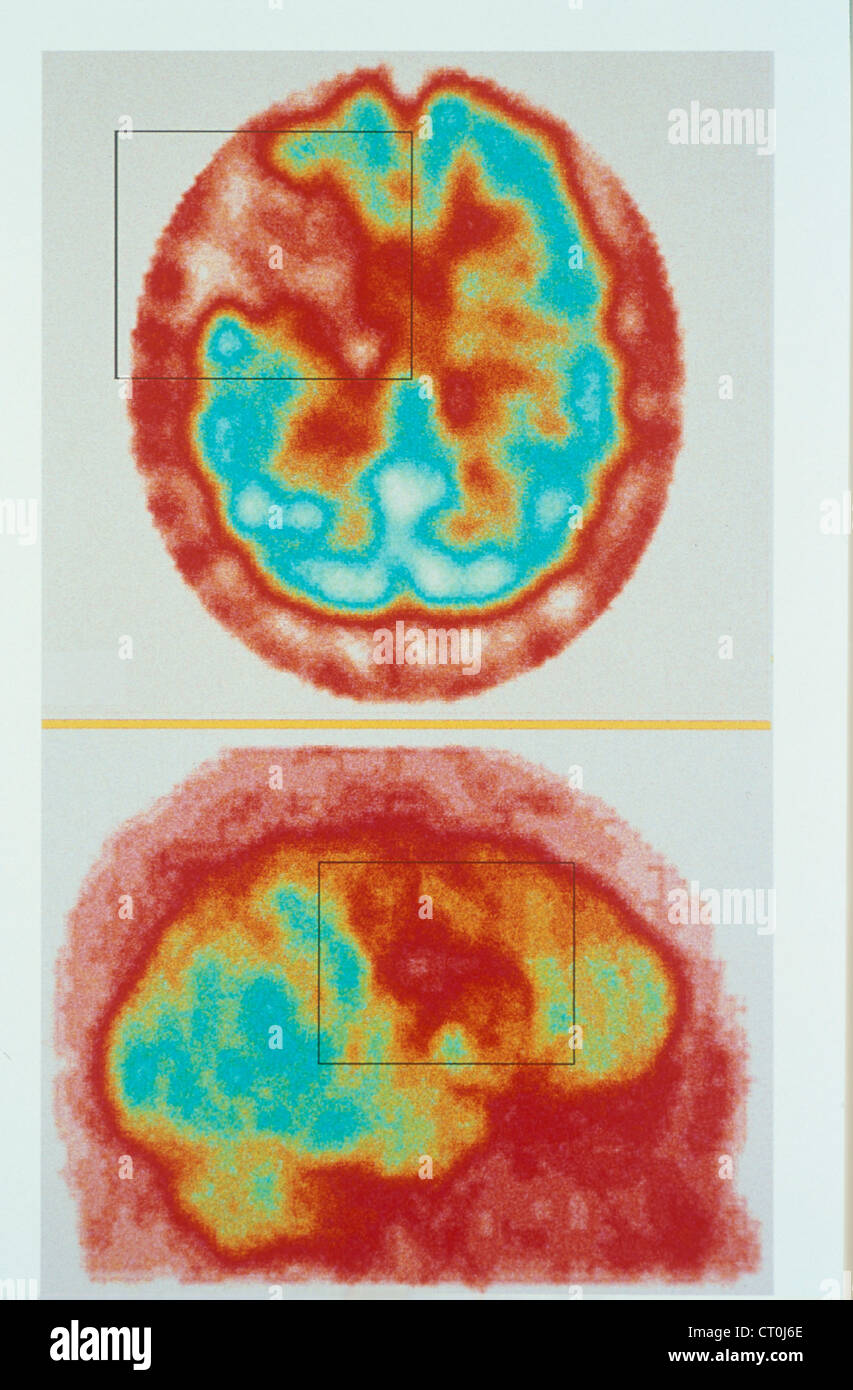 Vascularisation Cerebral Banque De Photographies Et Dimages à Haute