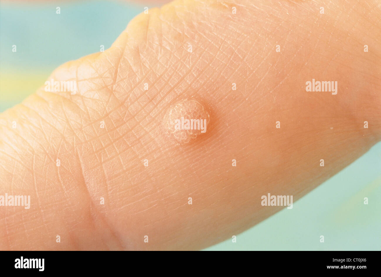 Verrues cutanées Banque de photographies et d’images à haute résolution ...