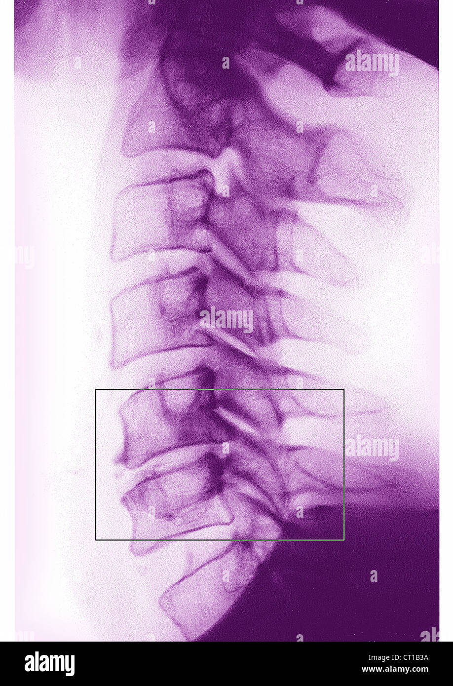 Rachis cervical cou arthrose Banque de photographies et d’images à ...