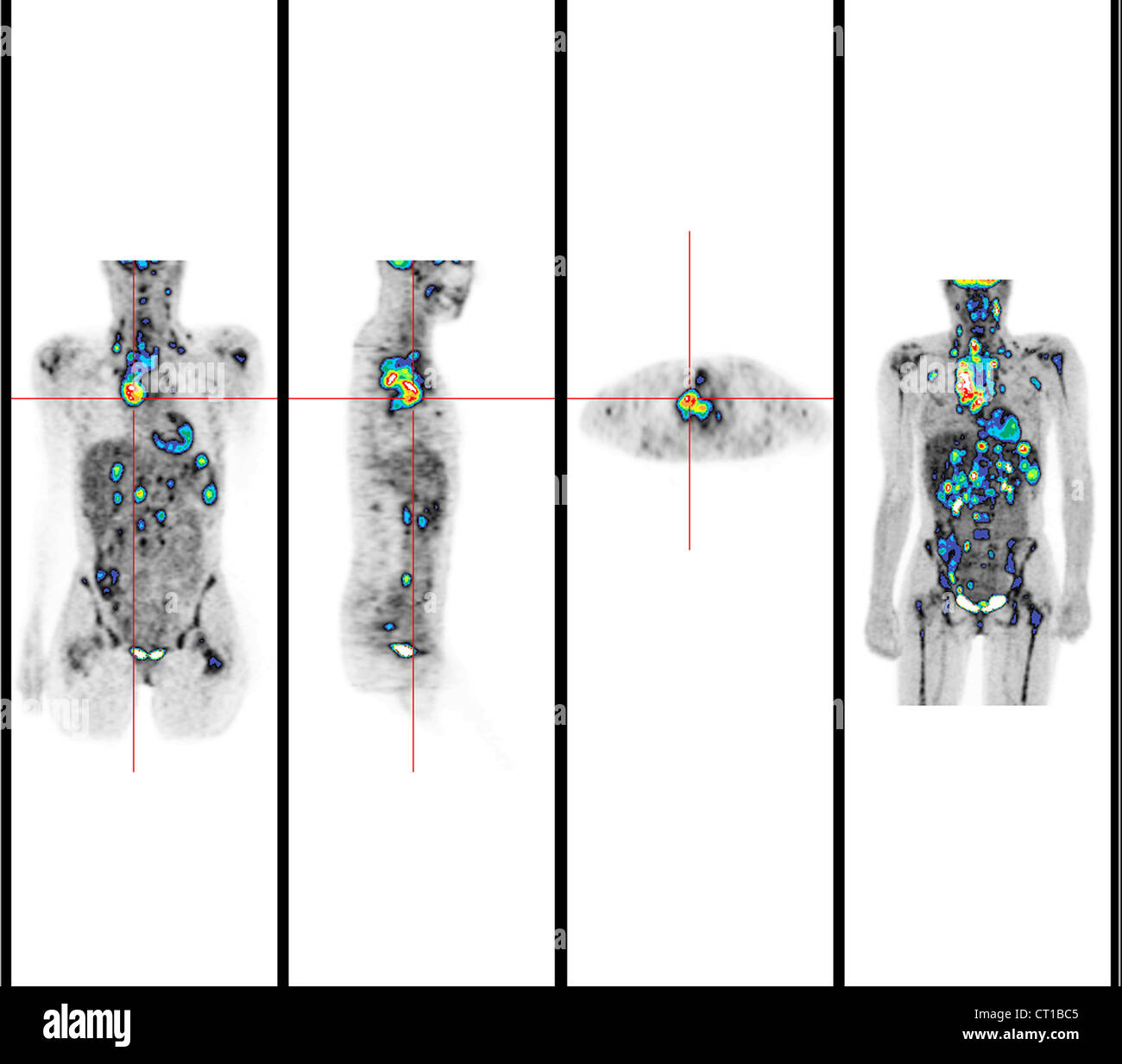 Maladie de hodgkin Banque de photographies et d’images à haute ...