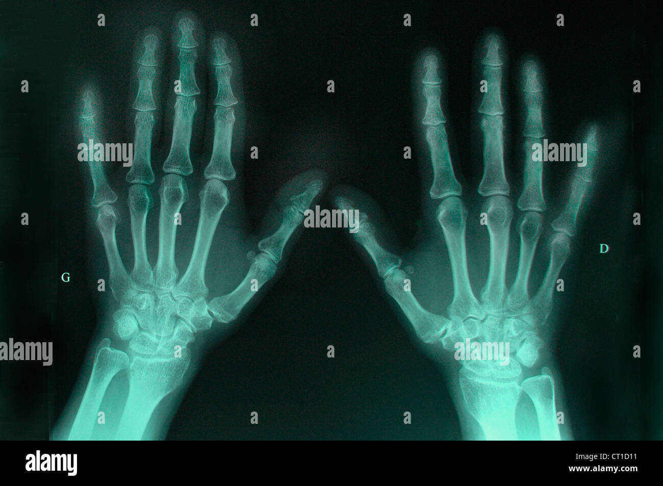 Rayons x de la main Banque de photographies et d’images à haute ...