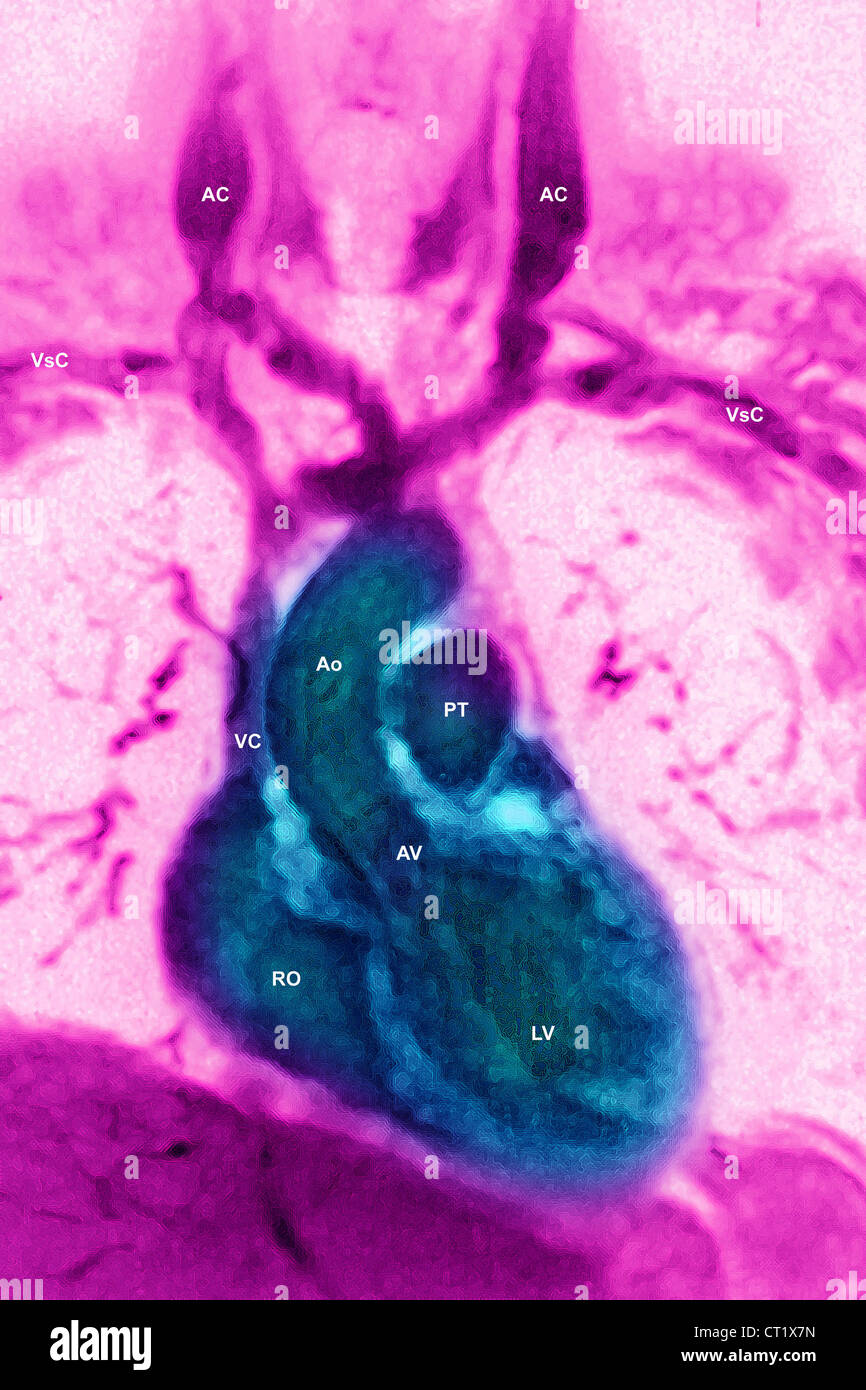 Pathologie des valvules cardiaques Banque de photographies et d’images ...