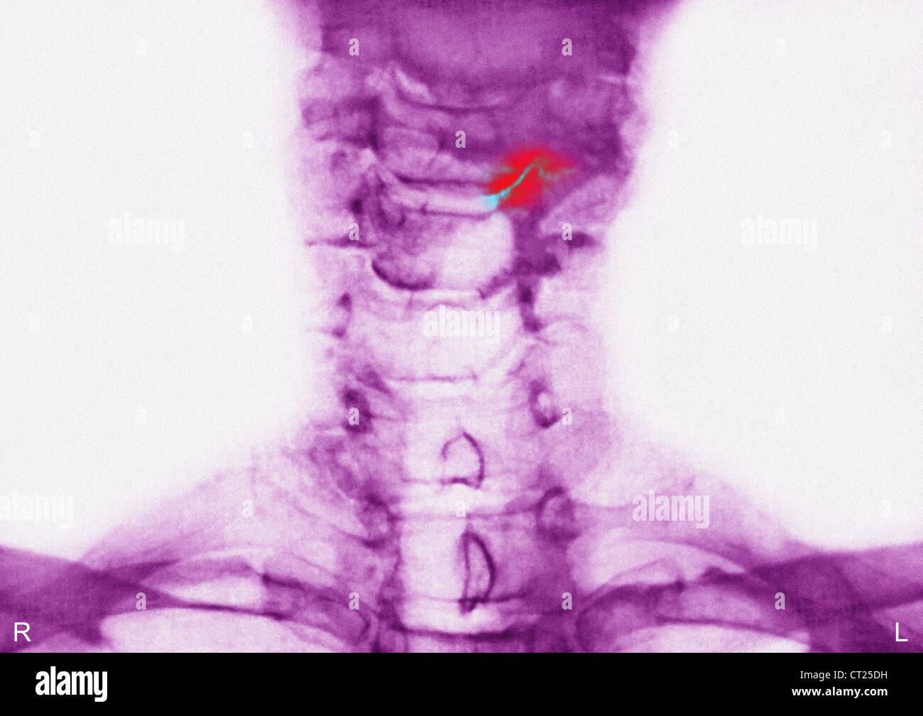 Rachis cervical cou arthrose Banque de photographies et d’images à ...