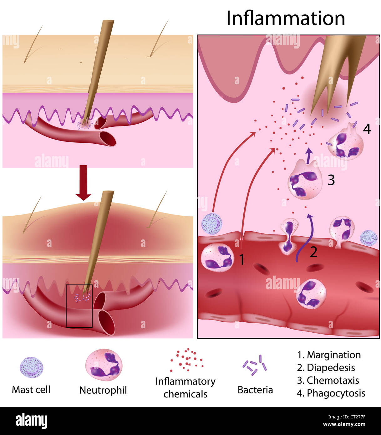 Processus de l'inflammation Photo Stock - Alamy