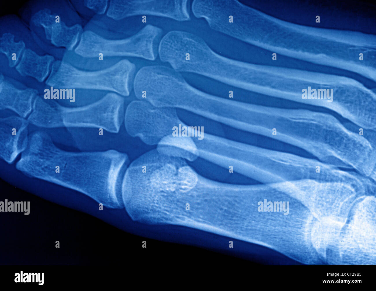 Verrue plantaire Banque de photographies et d’images à haute résolution ...