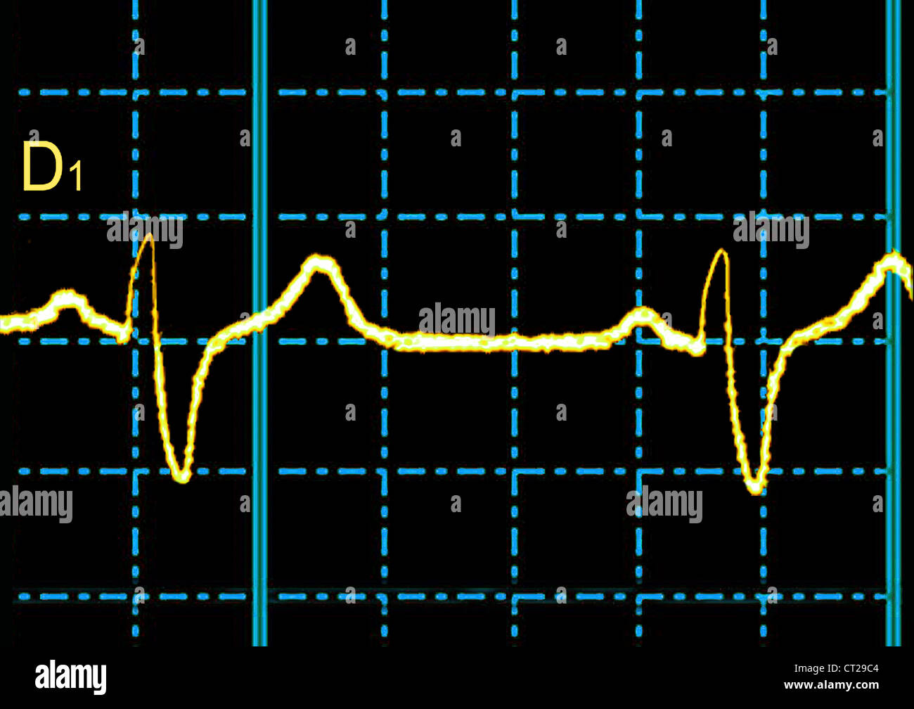 Right bundle branch block Banque de photographies et d’images à haute ...