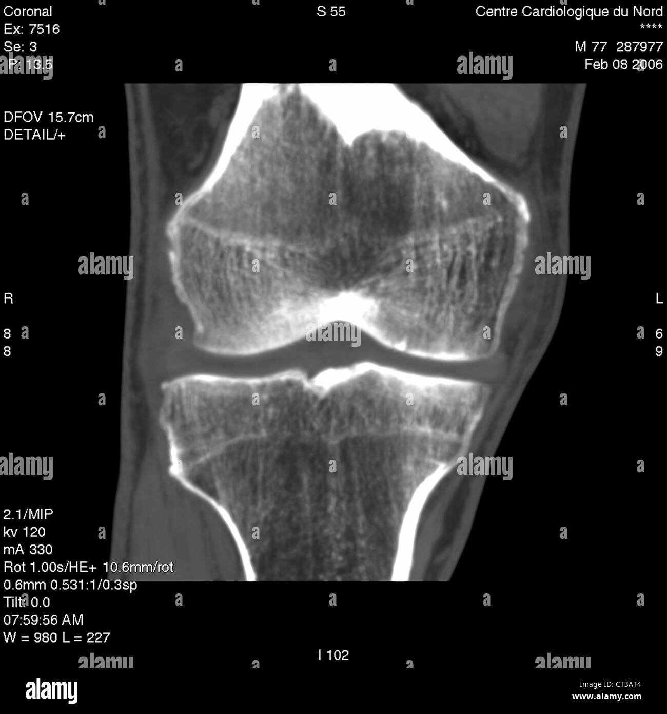 Genoux genou Banque d'images noir et blanc - Alamy